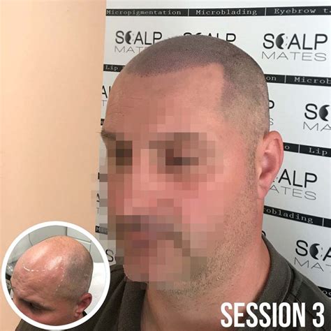 Blog The Best Non Surgical Solution To Hair Loss And Hair Thinning