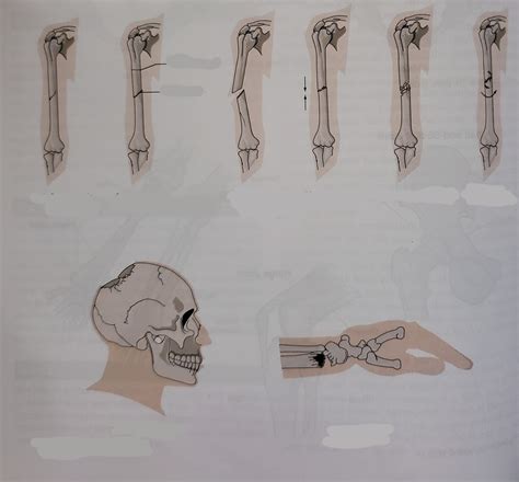 Fractures Diagram Quizlet