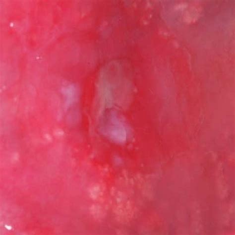 Clinical Aspect Of The Right Buccal Mucosa Ulcer With An Erythematous