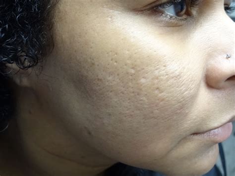 Tca Cross For Ice Pick Acne Scars Dr Craig Singer Md