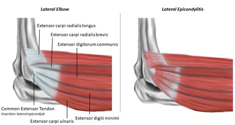 Lateral Epicondylitis Lateral Epicondylitis Tennis Elbow