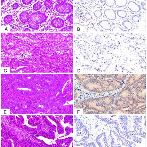 Tissue Microarray And Ihc Staining Of Ssh1 In Gc Tissues A Tissue