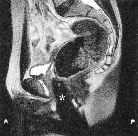Sagittal Turbo Spin Echo T2 Weighted Image Shows An Inflatable Silicon Download Scientific