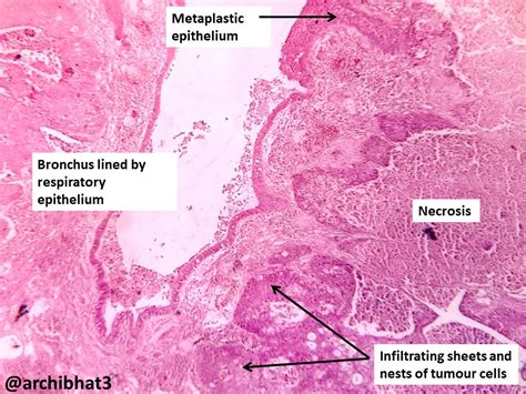 Squamous Cell Carcinoma Lung Gross
