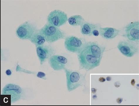 Langerhans Cell Histiocytosis Lung