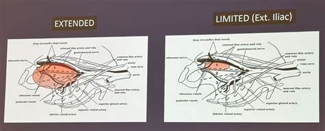 Aua 2023 Role And Extent Of Pelvic Lymph Node Dissection In Psma Era
