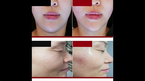 고강도 집중 초음파 피부관리 기기💎쿠마 하이푸 Youtube