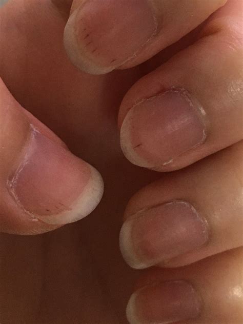 손톱에 검은 줄 지식in