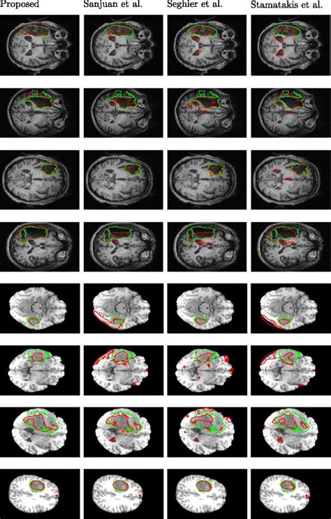 Sample Results Of Lesion Detection Using The Proposed Method And The