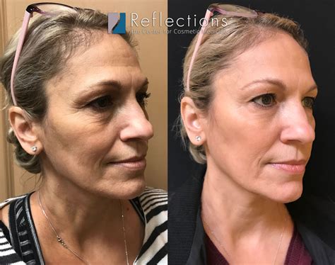 Liquid Facelift With Voluma And Botox Before After Photos New Jersey