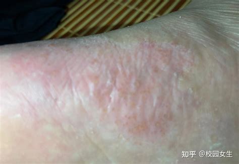 汗疱疹原因是什么和脚气怎么区分 知乎