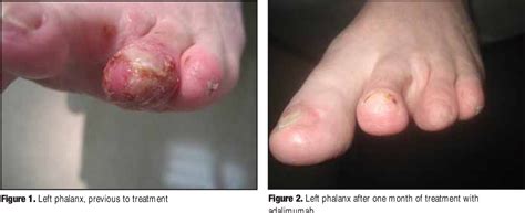 Figure 1 From Acrodermatitis Continua Of Hallopeau Successfully Treated