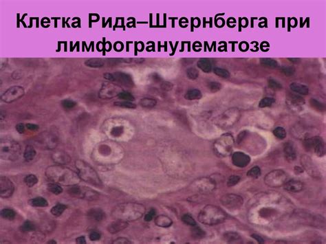 Патология клеток крови и костного мозга Опухоли из гемопоэтических тканей Болезнь Ходжкина