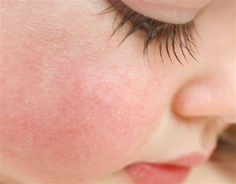 Flushed Cheeks In Adults