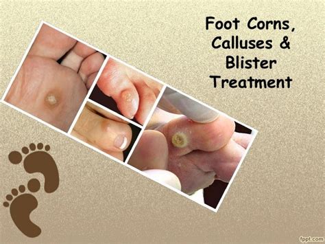 Foot Corns Calluses And Blister Treatment