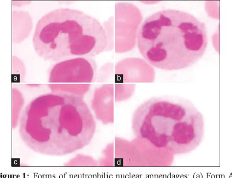 Figure 1 From Reliability Of Neutrophilic Nuclear Appendages In