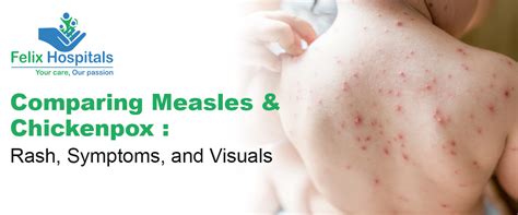 Comparing Measles And Chickenpox Rash Symptoms And Visuals