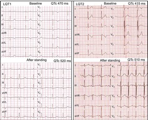 Value Of The “standing Test” In The Diagnosis And Evaluation Of Beta Blocker Therapy Response In