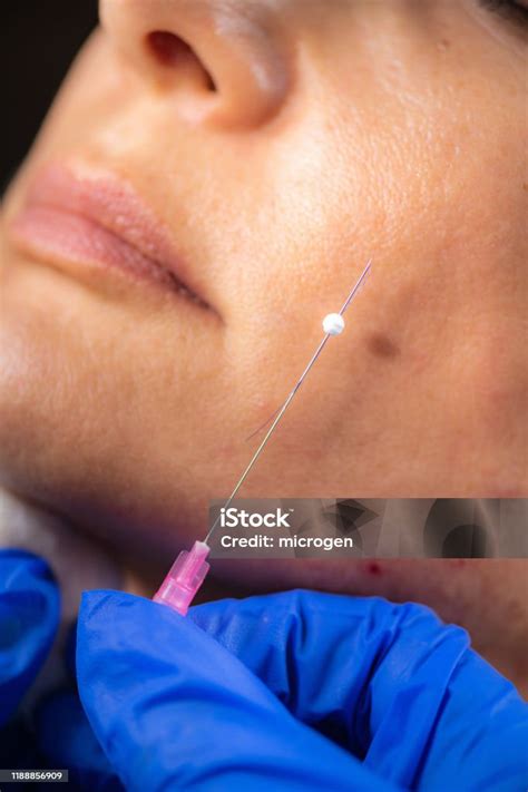 3d 메소 스레드와 미용 의학 얼굴 윤곽 실 봉제 제품에 대한 스톡 사진 및 기타 이미지 실 봉제 제품 3차원 형태 40 49세 Istock