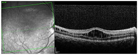The Ophthalmology Residents Guide To Inherited Macular Dystrophies