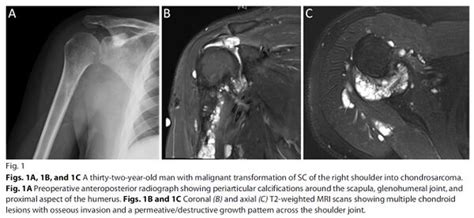 Synovial Osteochondromatosis Wikism Sports Medicine Wiki