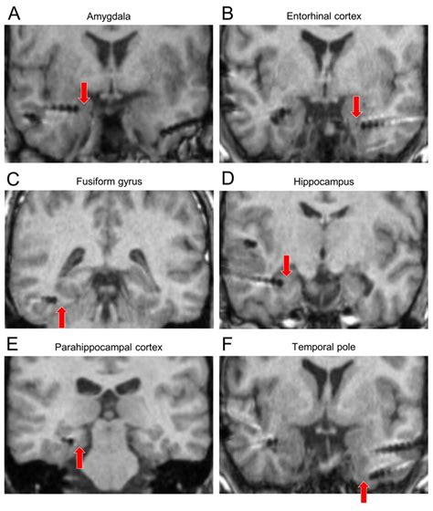 Fig S1 Examples Of Microelectrode Locations A F Example Download Scientific Diagram