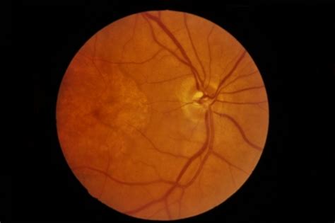 Central Areolar Choroidal Dystrophy Retina Image Bank