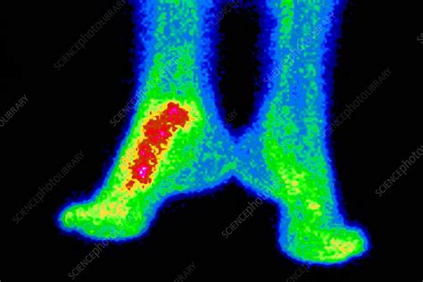 Algodystrophy Scintigram Stock Image C0018077 Science Photo Library