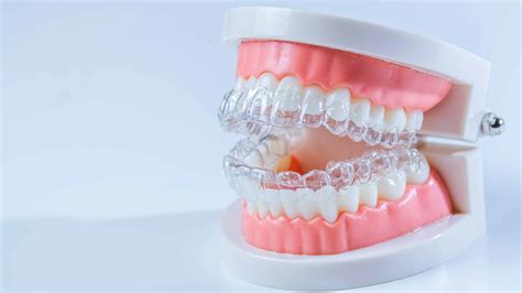 What Is An Essix Retainer Benefits Care And Usage Explained