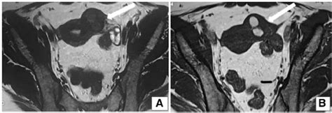 A Mri T2 Weighted Image Shows Heterogeneously Hypointense Lesion