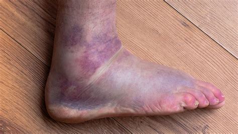 Sprained Ankle