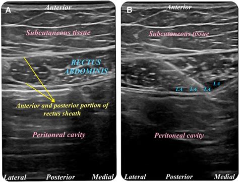 The Effect Of Ultrasound Guided Rectus Sheath Block On Posto Medicine