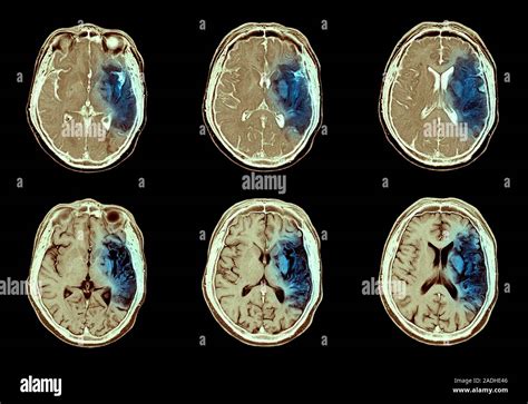 Stroke Coloured Computed Tomography Ct Brain Scans Axial View Through The Brain Of A 38