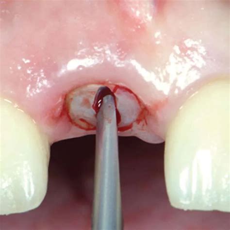 Fractured Broken Root Extractions Tips 1 Emergency Dentistry