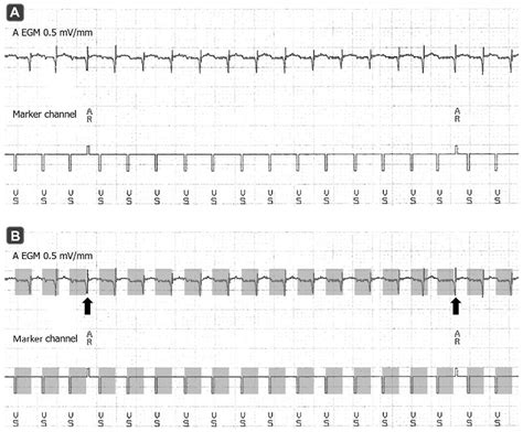 Figure 3 From Broad Complex Tachycardia In A Patient With A Pacemaker What Is The Mechanism