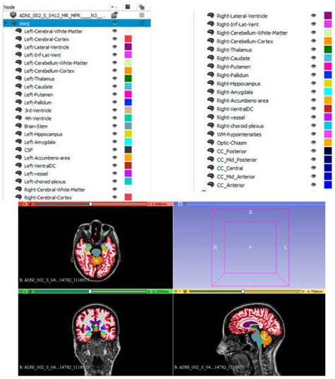 Integrating Demographics And Imaging Features For Various Stages Of Dementia Classification