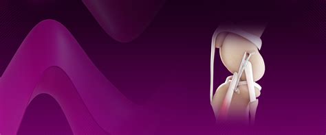 Extracapsular Fixation For Cranial Cruciate Ligament Rupture Procedures Vetluc