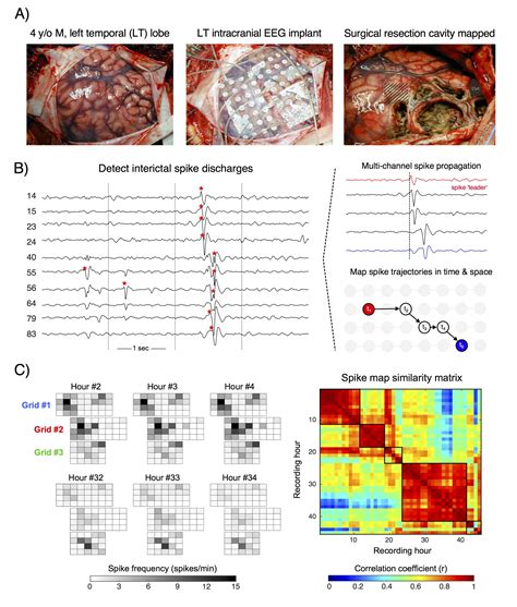 Fluctuating Spike Patterns In Long Term Intracranial Recordings Among Pediatric Patients