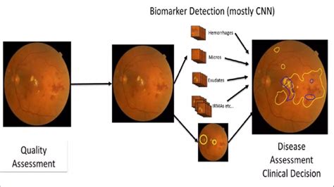 Use Of Artificial Intelligence Dr Mata System For The Detection And Intervention Of Diabetic