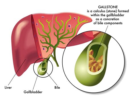Westerville Surgical Specialists Gallbladder Removal