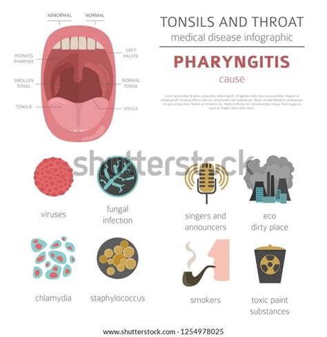 Vektor Stok Tonsils Throat Diseases Pharyngitis Symptoms Treatment