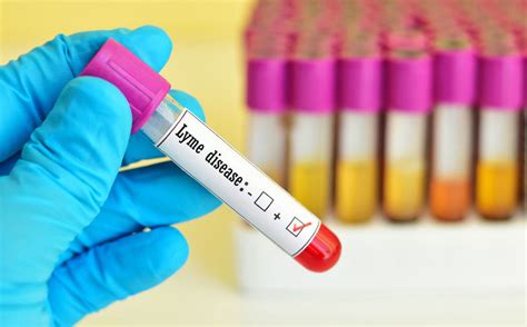 Enfermedad de Lyme qué es y cuáles son sus síntomas Grupo Milenio