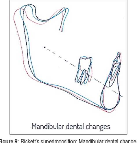 Figure 1 From Treatment Of Maxillary Hypoplasia With Bone Anchored