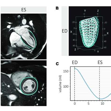 Image Analysis And 3d Left Ventricle Lv Geometry Extraction From Download Scientific Diagram