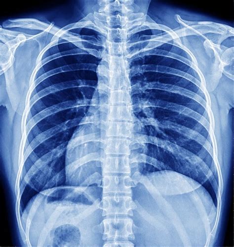 Nodule Spiculé Comprendre Ce Signe Radiologique Clé