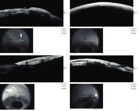 Anterior Segment Optical Coherence Tomography Appearance Of Bleb Download Scientific Diagram