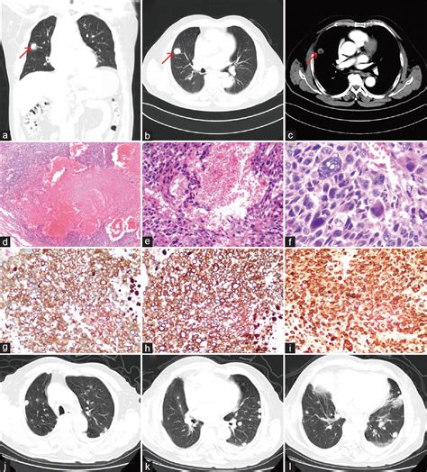 A Case Of Male Primary Pulmonary Choriocarcinoma Chinese Medical Journal