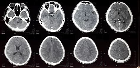 Contras Head Ct Scan Showed Leptomeningeal And Gyral Enhancement On