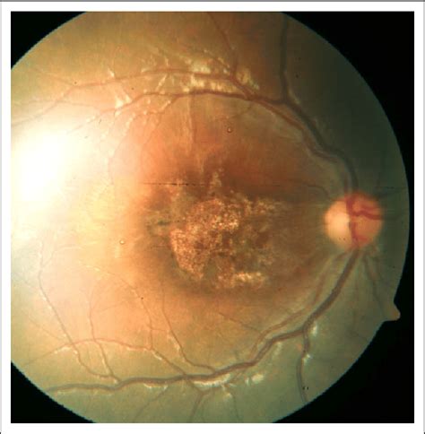 Fundus Photograph Of The Right Eye Showing Macular Scar With Atrophy Of