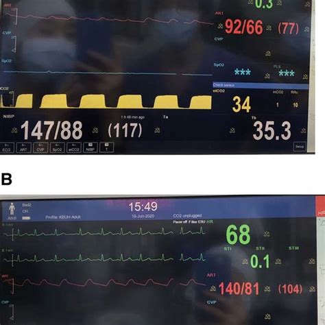 Screen Captures Of The Ecg Monitoring Device Show Sudden Arrhythmia Download Scientific Diagram